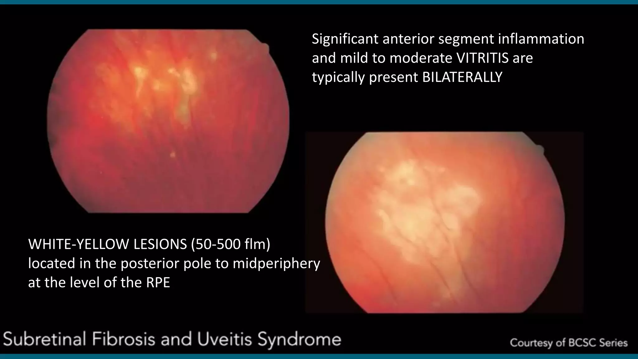 White dot syndrome | PPTX