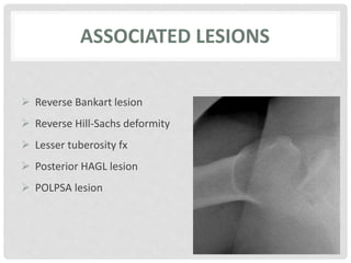 Posterior shoulder dislocation 2 | PPTX