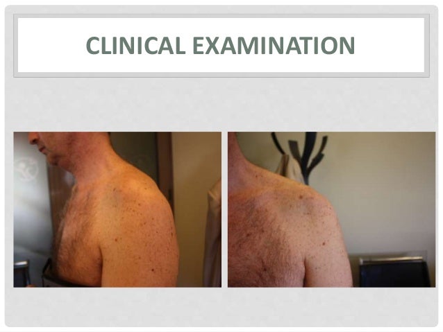 Posterior shoulder dislocation 2