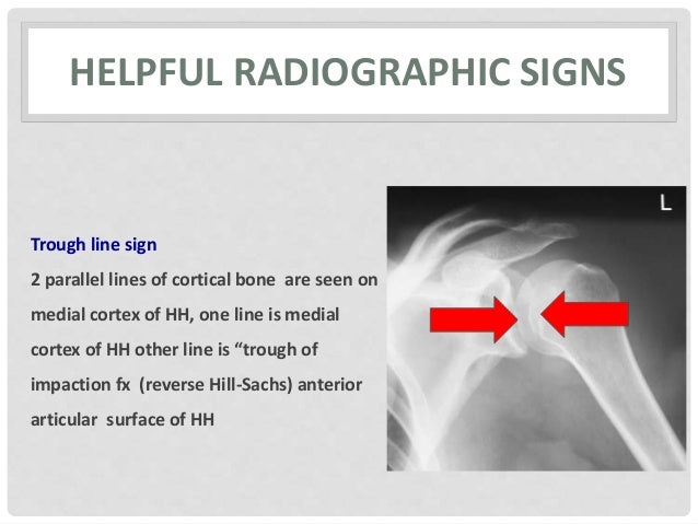 Posterior shoulder dislocation 2