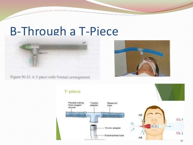 Weaning from mechanical Ventilation