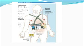 Wearable artififial kidney and bioimplantable kidney by Dr Vishnu RS | PPT