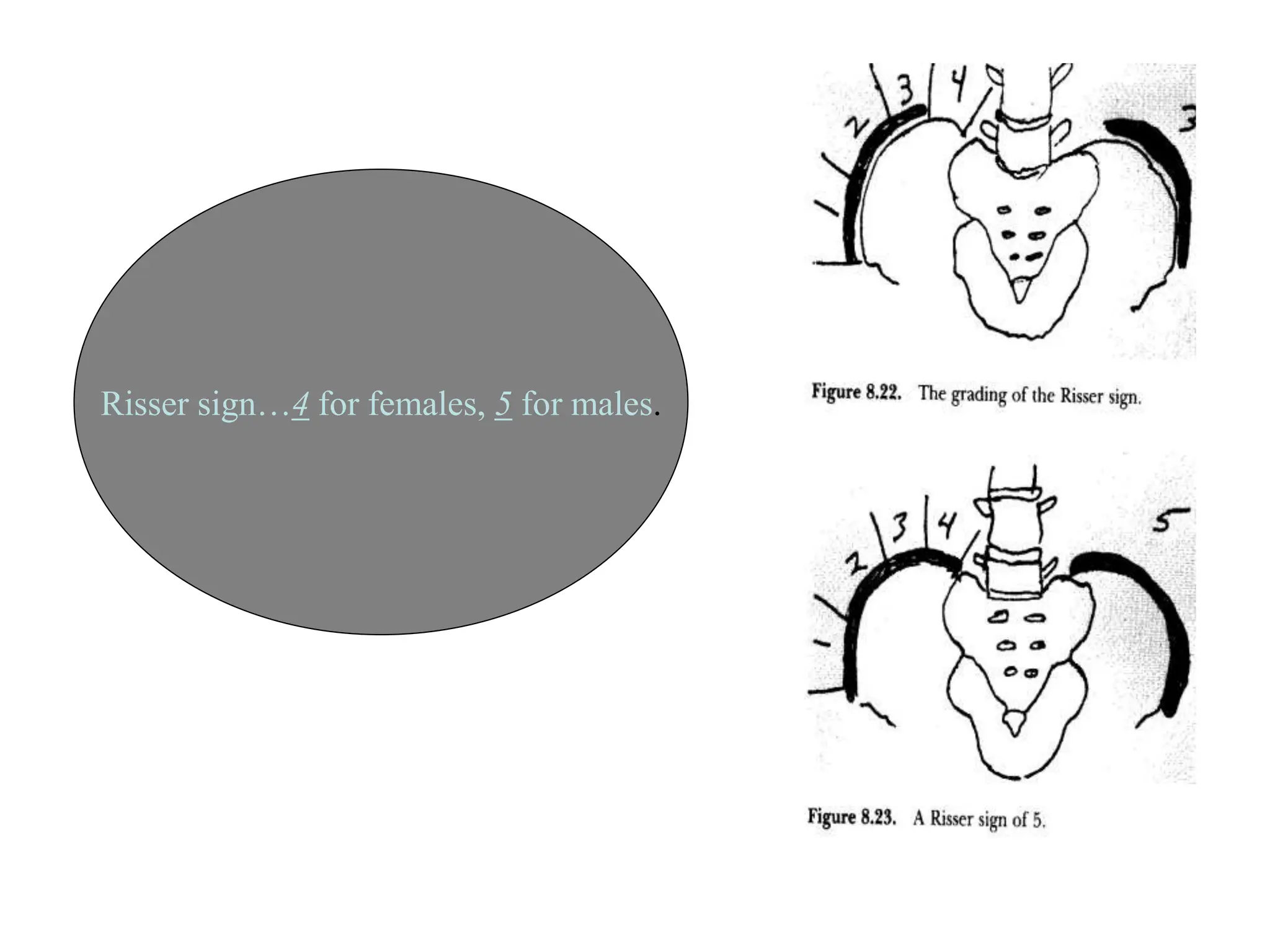 scoliosis management and defination with treatment | PPT