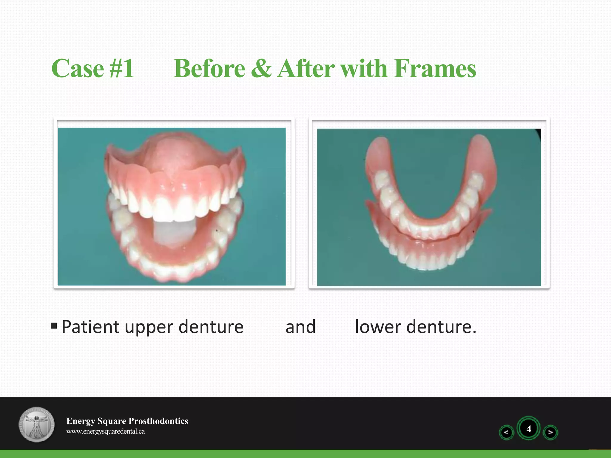 Complete Dentures | PPTX