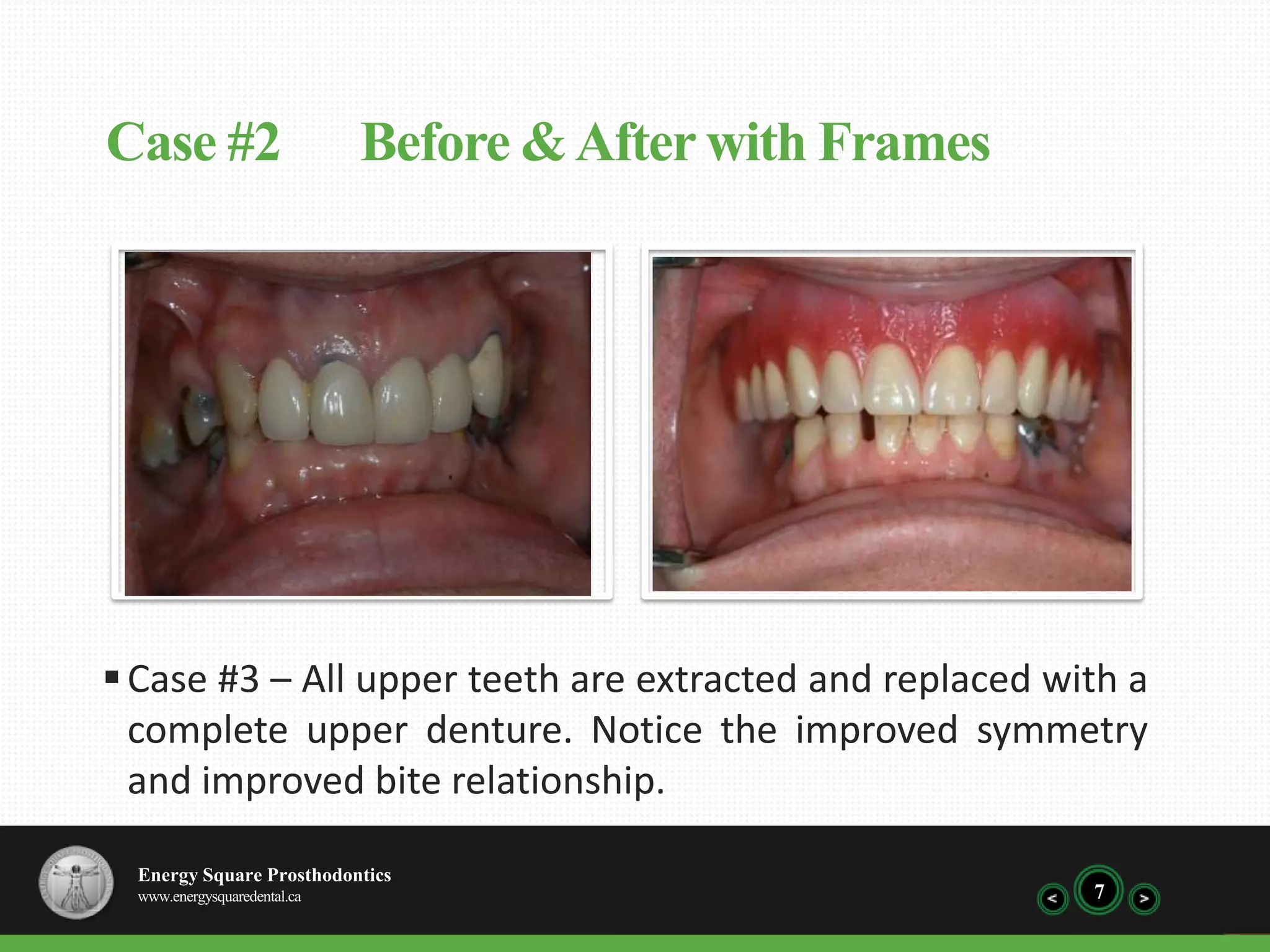 Complete Dentures | PPTX