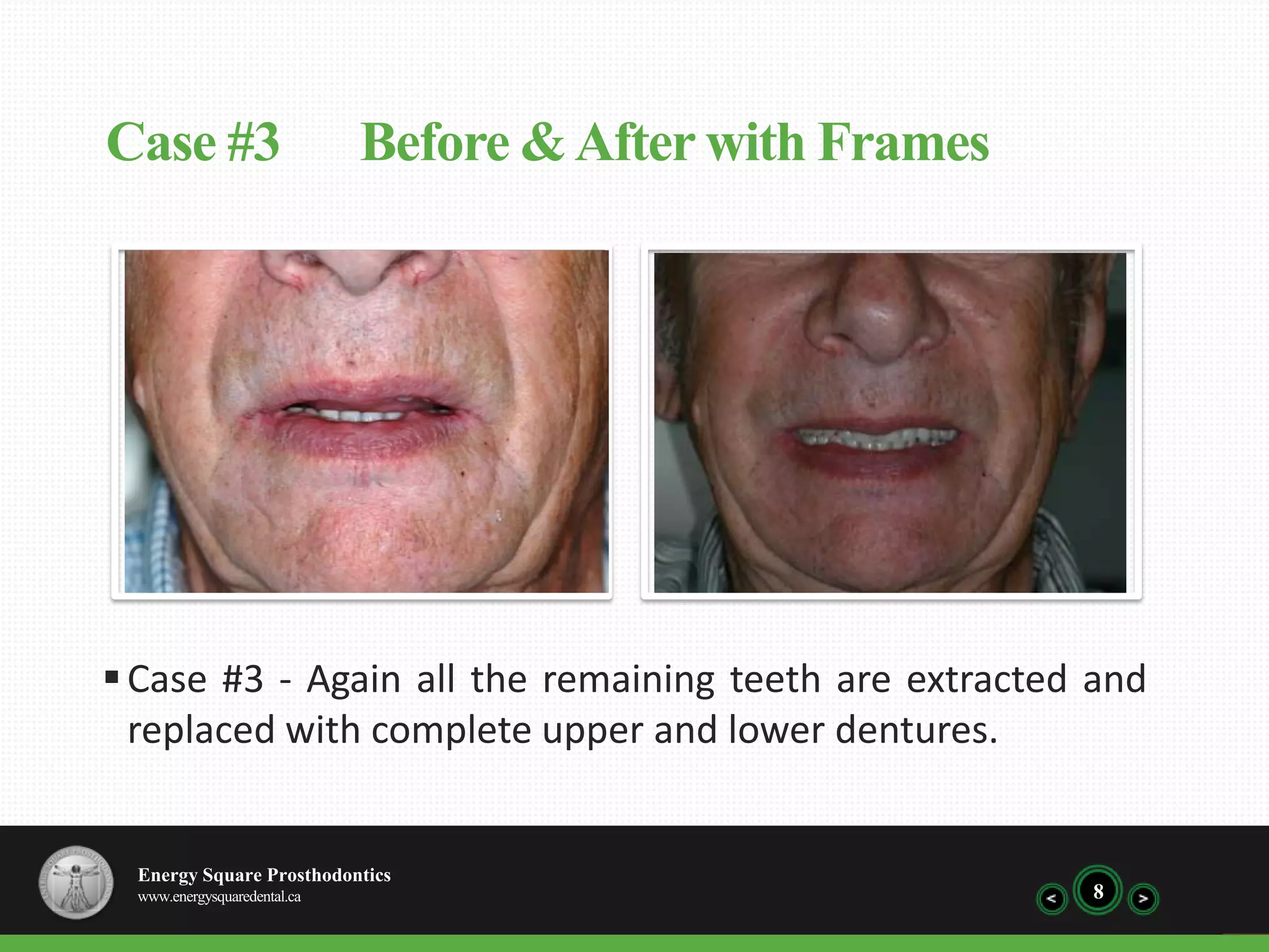 Complete Dentures | PPTX