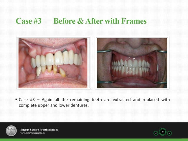 Complete Dentures | PPT