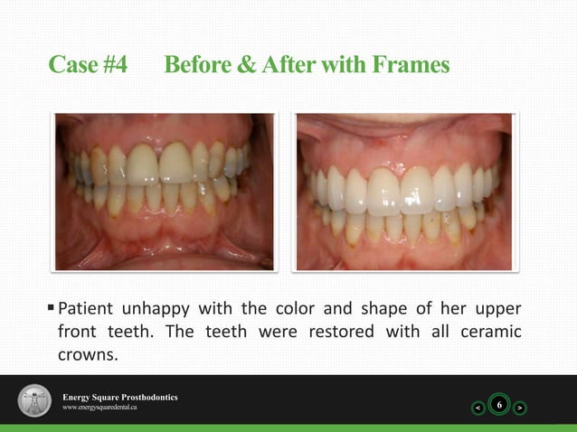 Crowns All Ceramic | PPTX