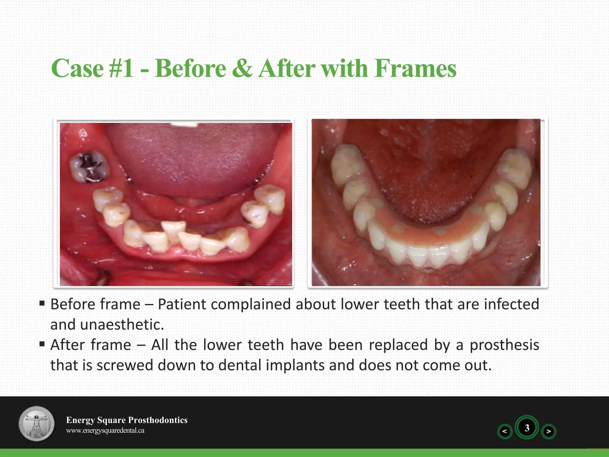 Denture Fixed Supported by Implants | PPTX