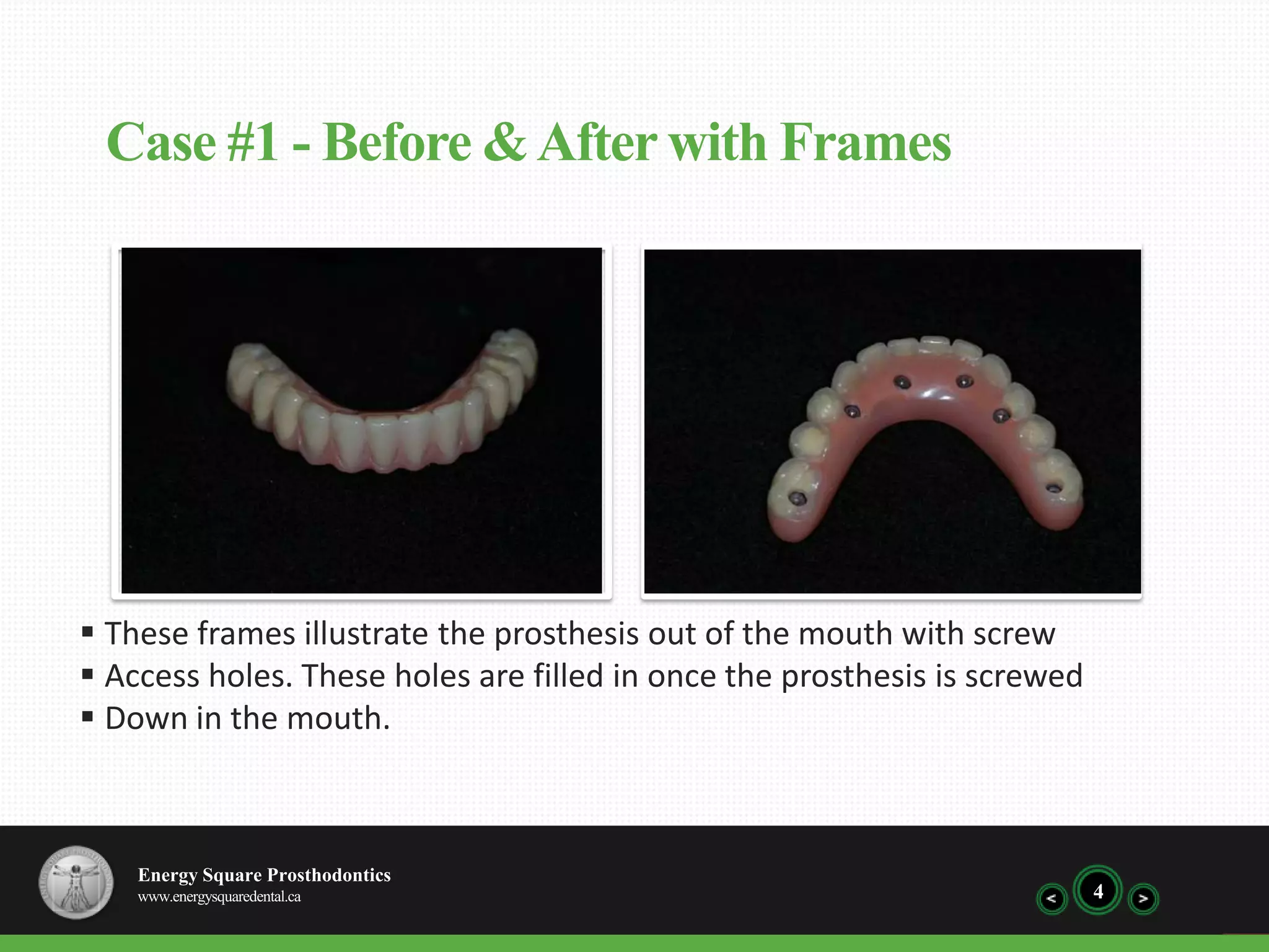 Denture Fixed Supported by Implants | PPTX