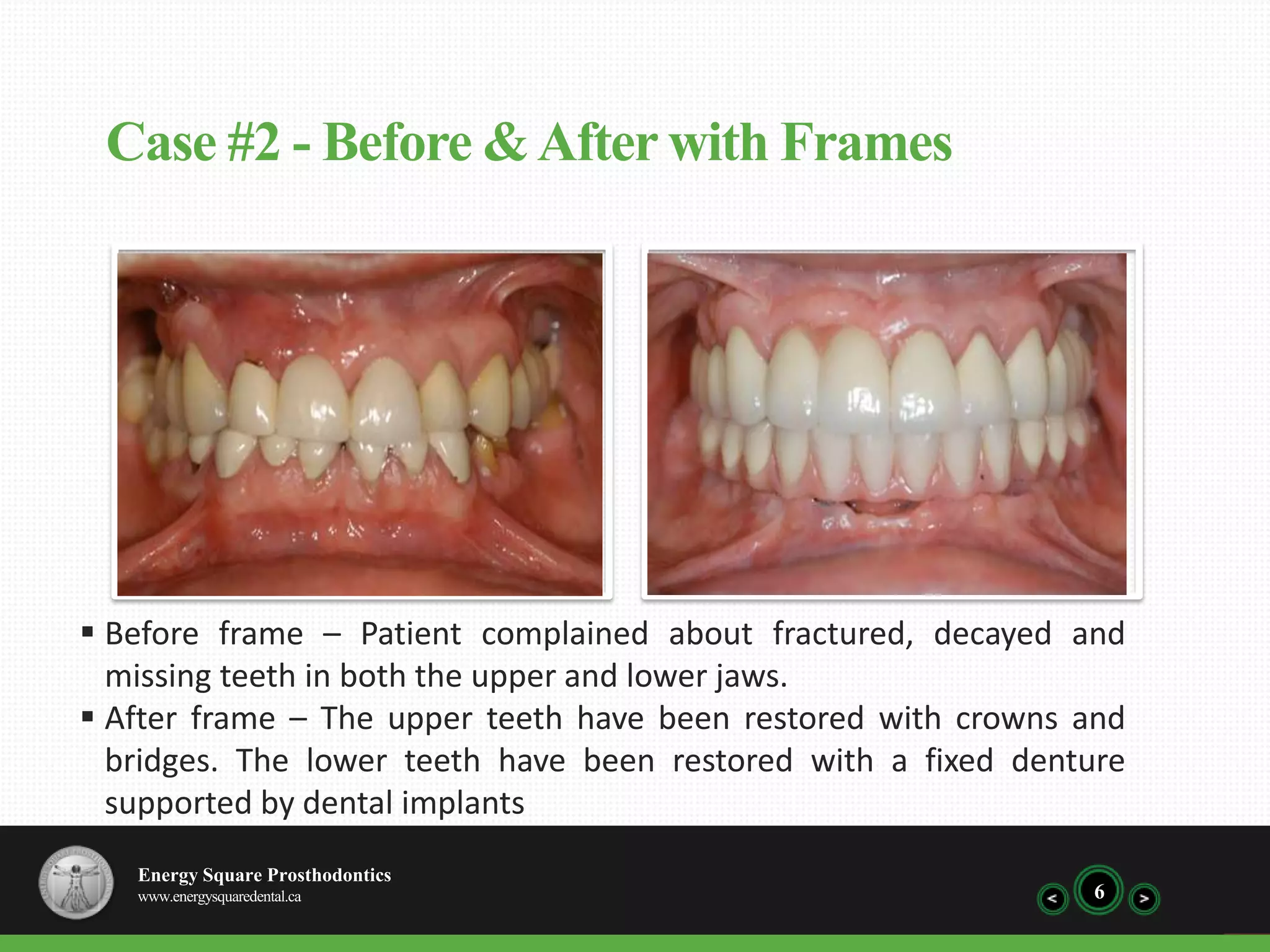 Denture Fixed Supported by Implants | PPTX