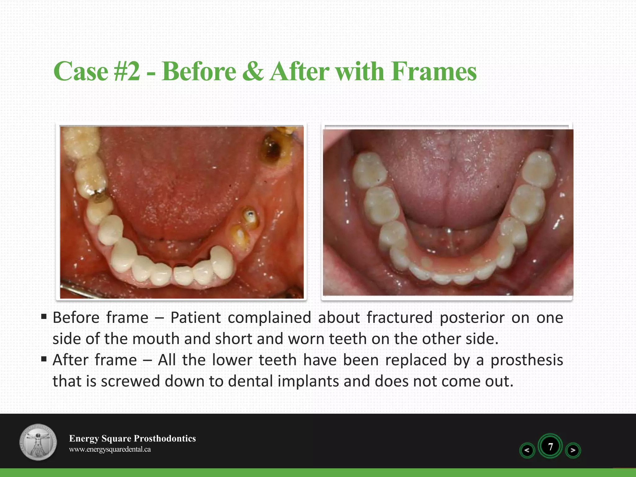 Denture Fixed Supported by Implants | PPTX