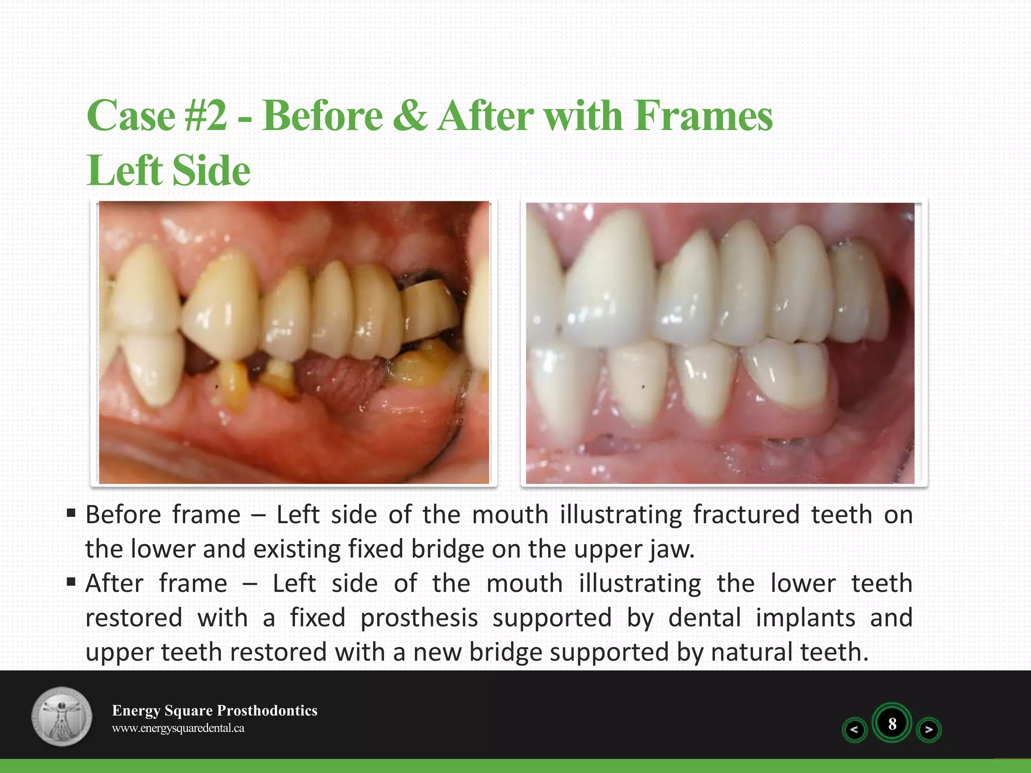 Denture Fixed Supported by Implants | PPTX