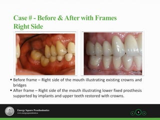 Denture Fixed Supported by Implants | PPTX