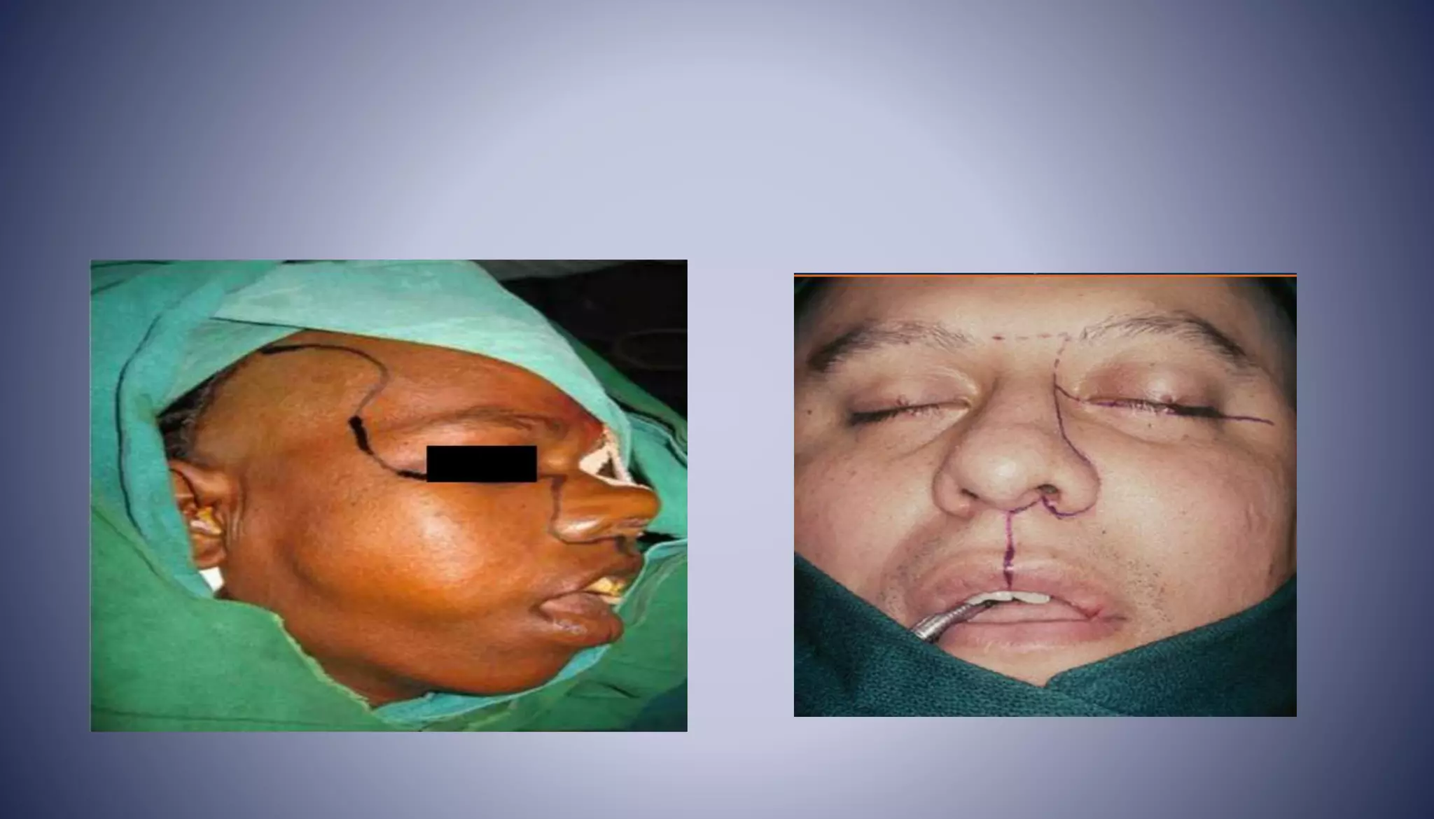 Weber ferguson incison (poster) | PPTX