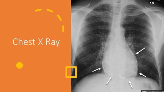 chronic constrictive pericarditis ideal short case presentation | PPT