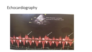 chronic constrictive pericarditis ideal short case presentation | PPTX