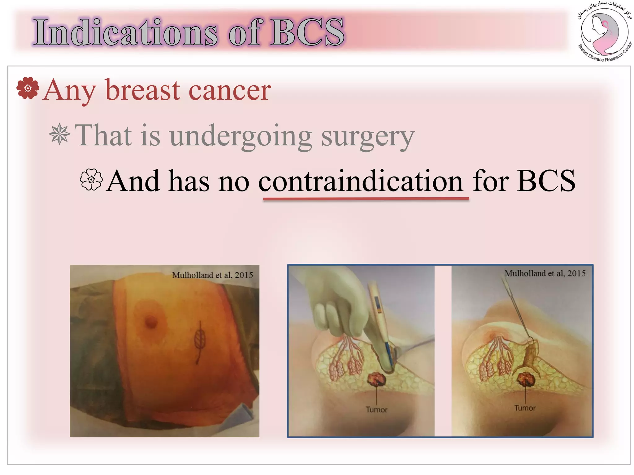 Oncoplastic Breast Surgery; Principles of Techniques and Indications | PDF