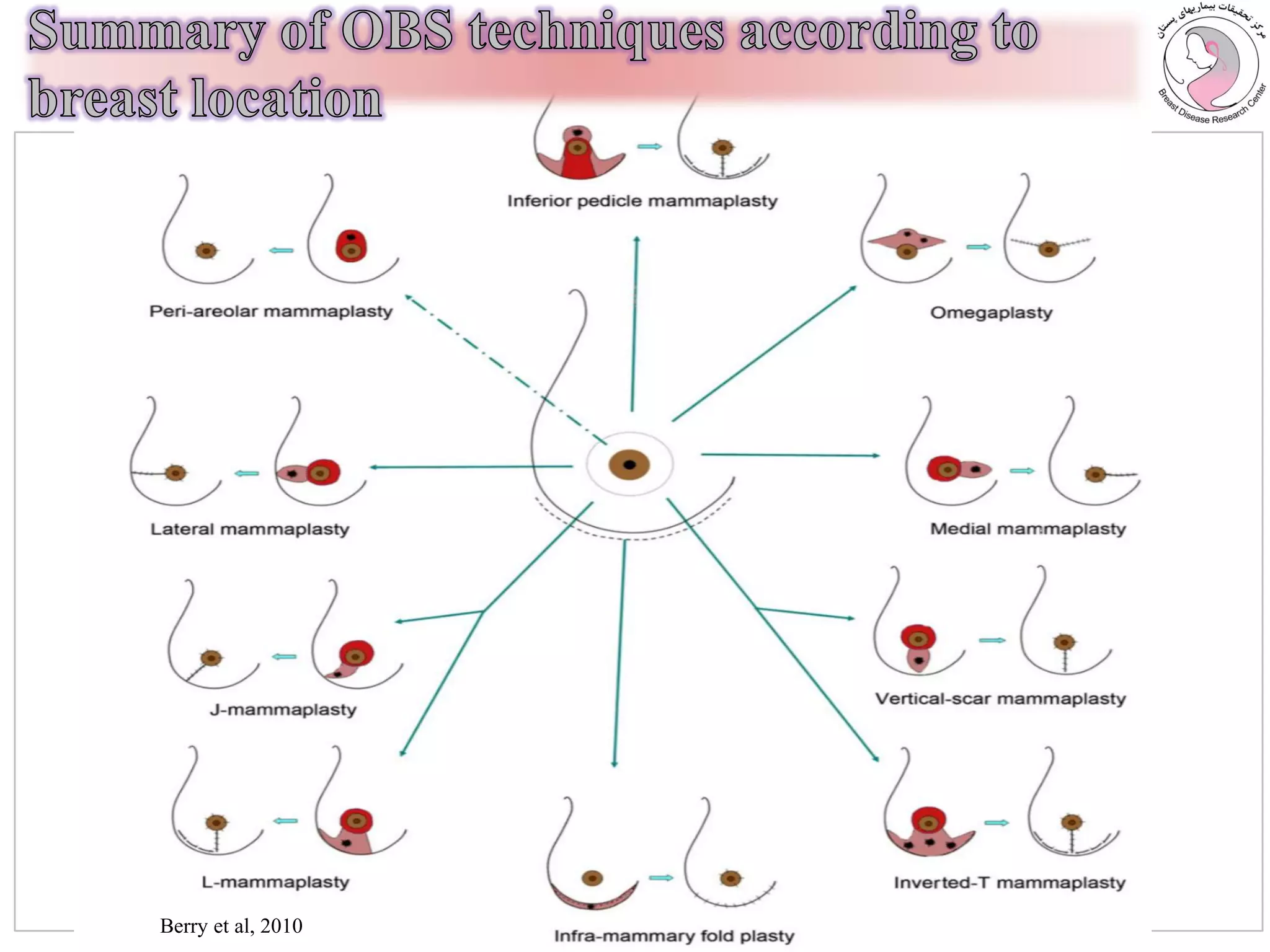 Oncoplastic Breast Surgery; Principles of Techniques and Indications | PDF