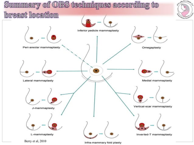 Oncoplastic Breast Surgery; Principles of Techniques and Indications ...