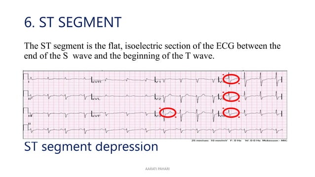ECG AND ITS INTERPRETATION.pptx