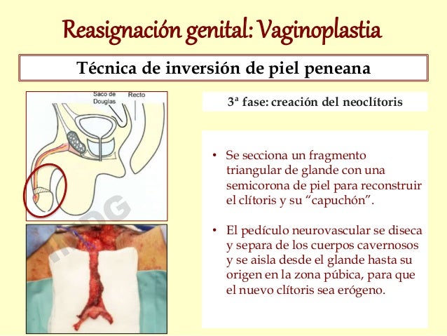 Reasignación genital femenina
