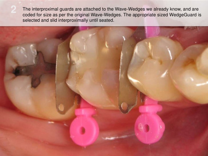 WedgeGuard MOD Case by Dr Graeme Milicich