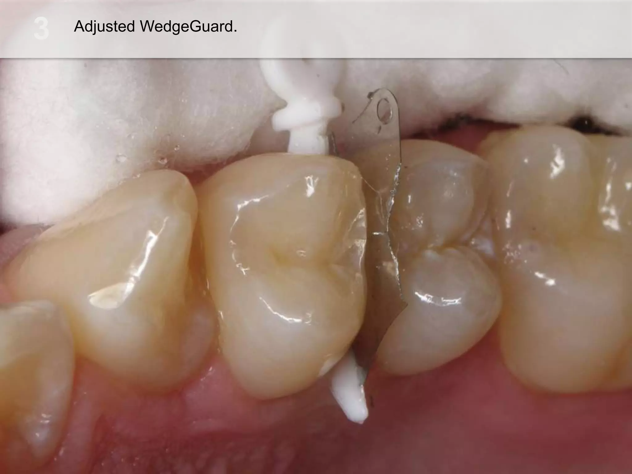 WedgeGuard MO/DO Case by Dr Graeme Milicich | PPTX