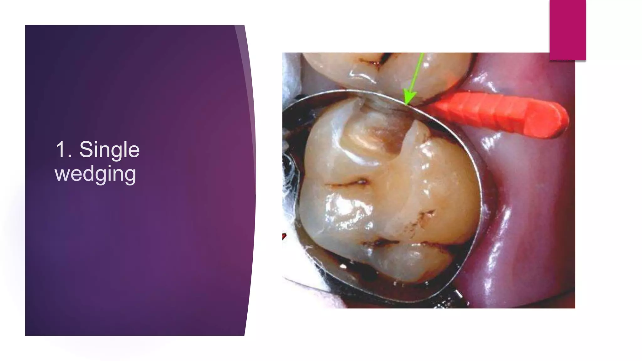 WEDGES & MATRIX II YR.pptx