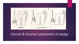 WEDGES & MATRIX II YR.pptx