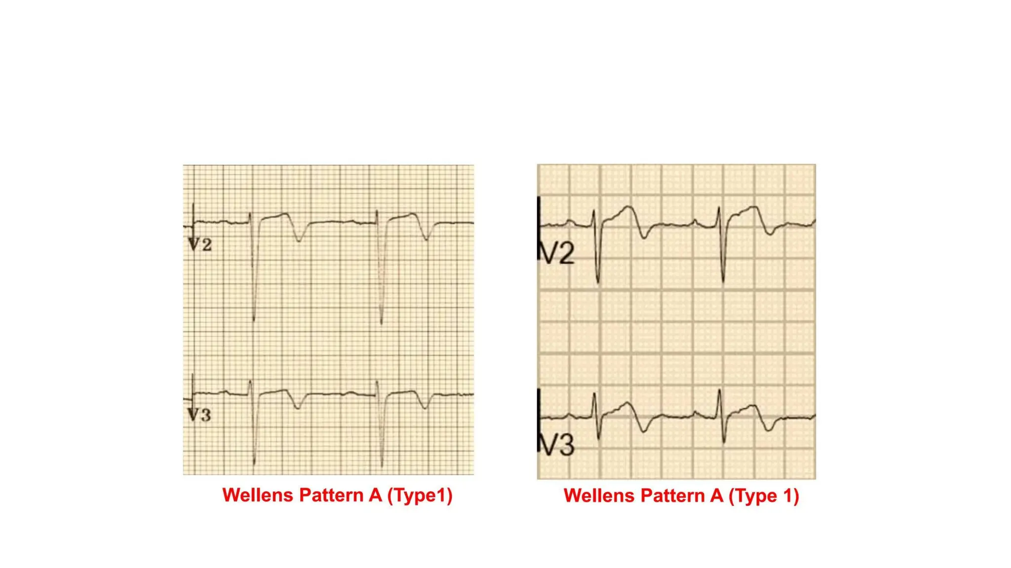 Week 17 Abnormal ECG Interpretation.pptx