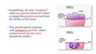 week+3+lect+3+-first+lect+Exophytic+Oral+Lesions.pdf