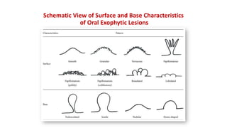 week+3+lect+3+-first+lect+Exophytic+Oral+Lesions.pdf