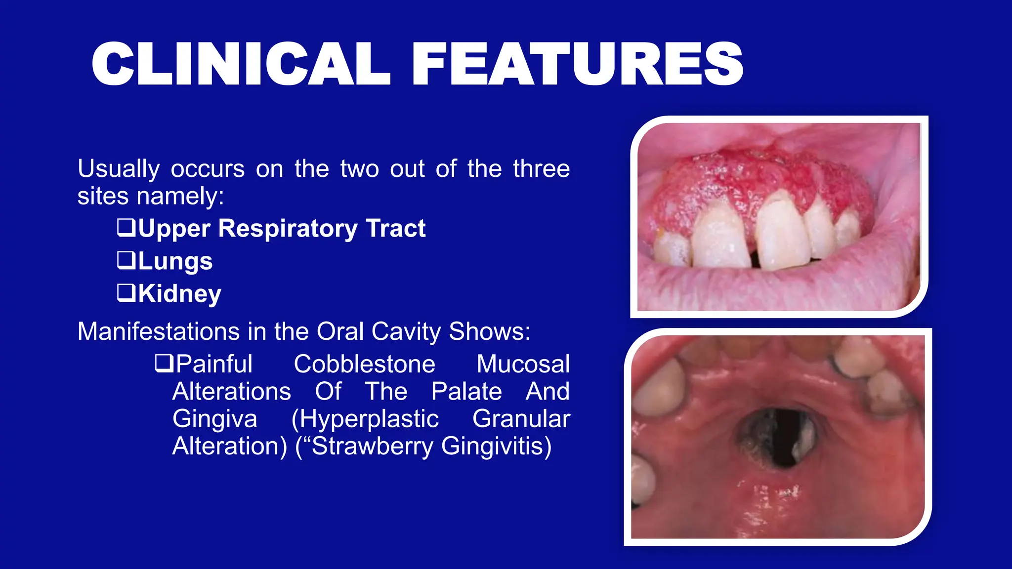WEGENER’S GRANULOMATOSIS (GRANULOMATOSIS WITH POLYANGIITIS).pptx