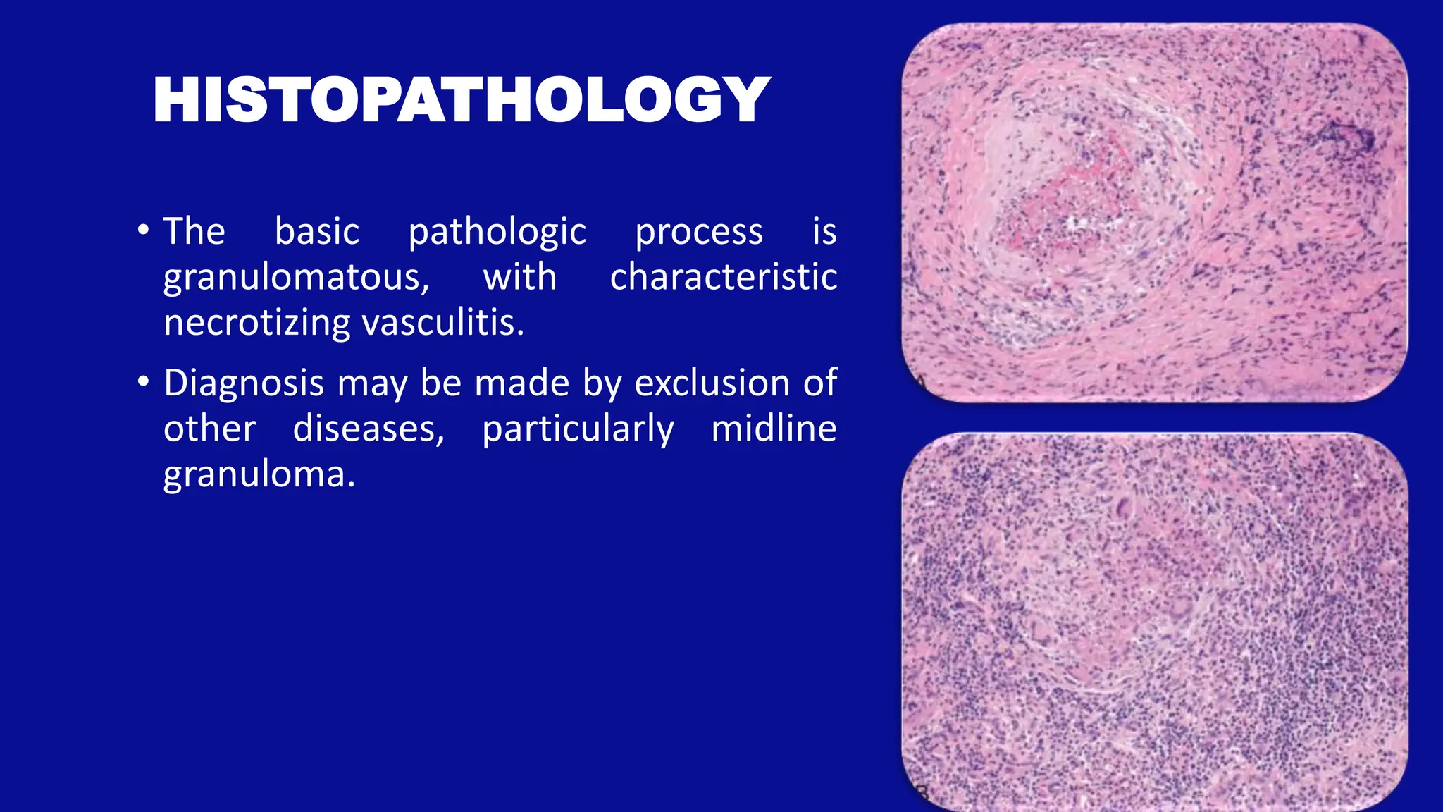 WEGENER’S GRANULOMATOSIS (GRANULOMATOSIS WITH POLYANGIITIS).pptx