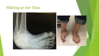 TalipesEquinoVarus.pptx