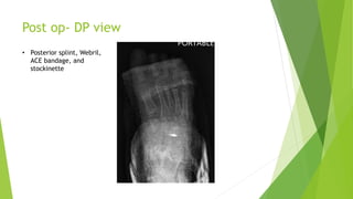 TalipesEquinoVarus.pptx