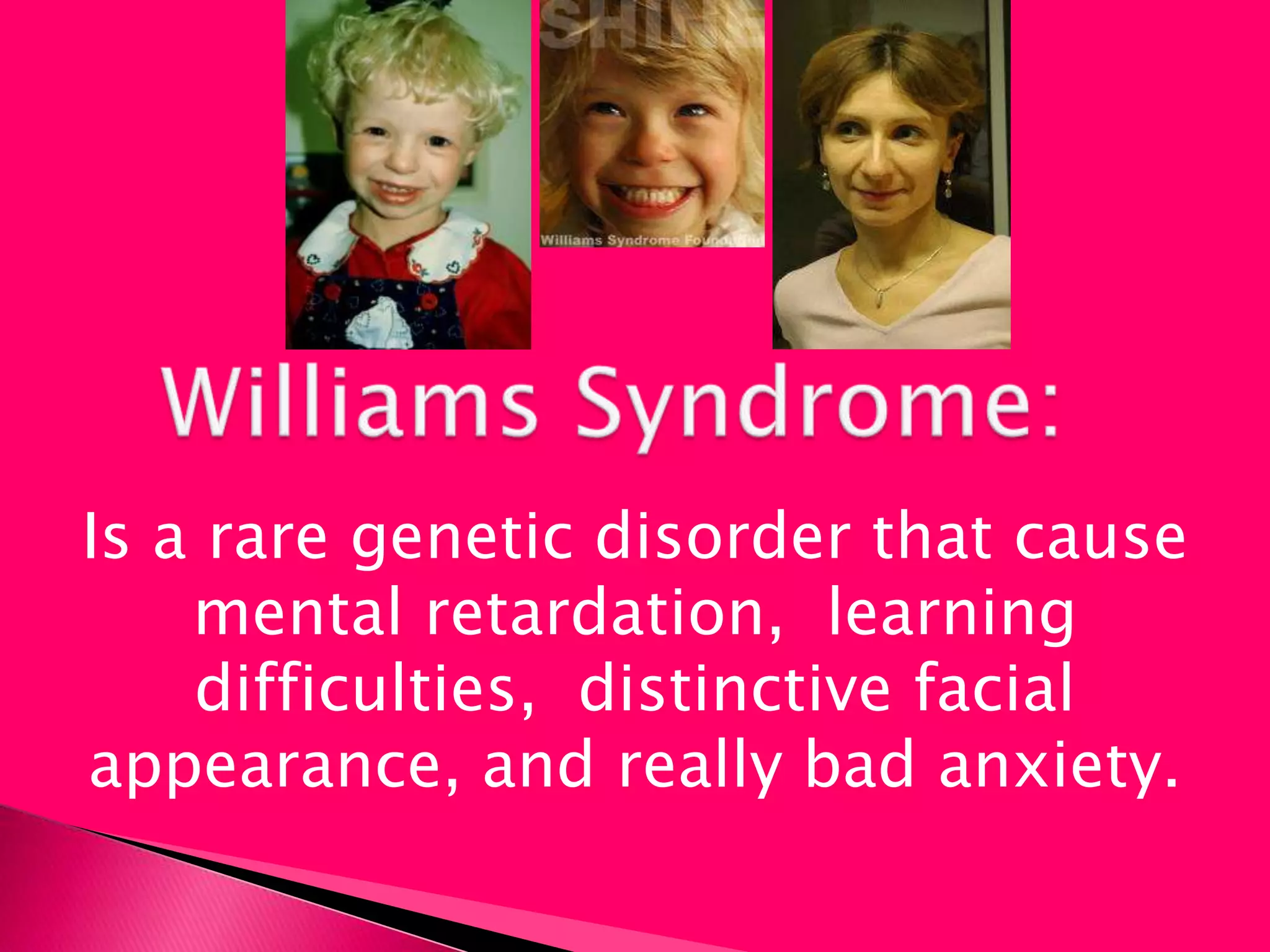 Williams Syndrome | PPTX