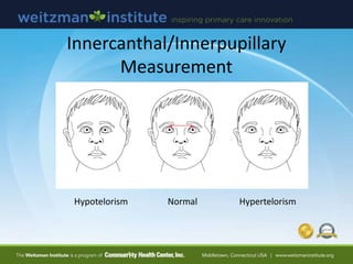 Hypertelorism Measurement