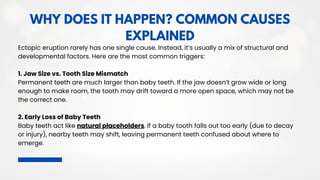 Ectopic Eruption: Why Some Teeth Grow in the Wrong Place | PDF