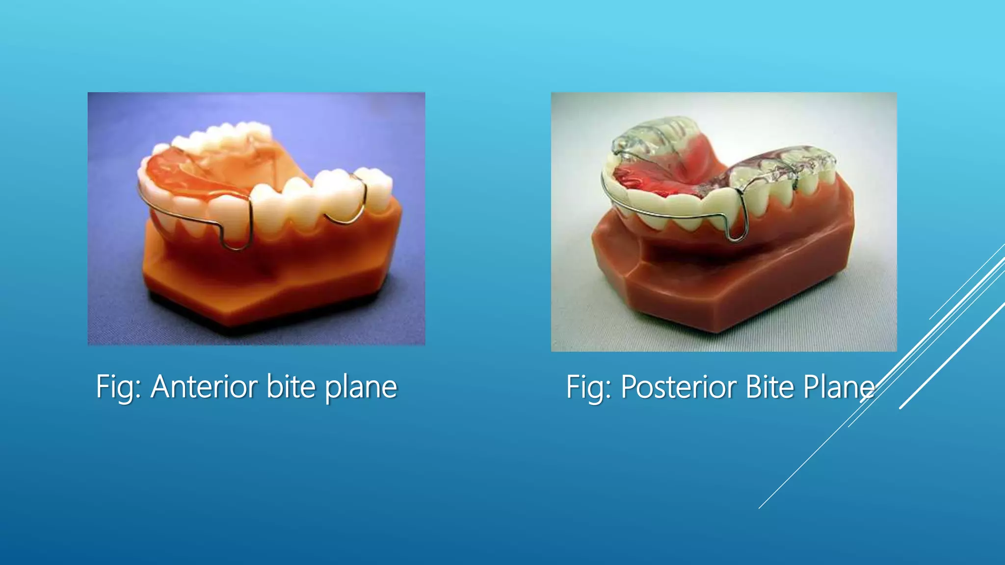 Oral screen and mixed dentition appliance | PPTX