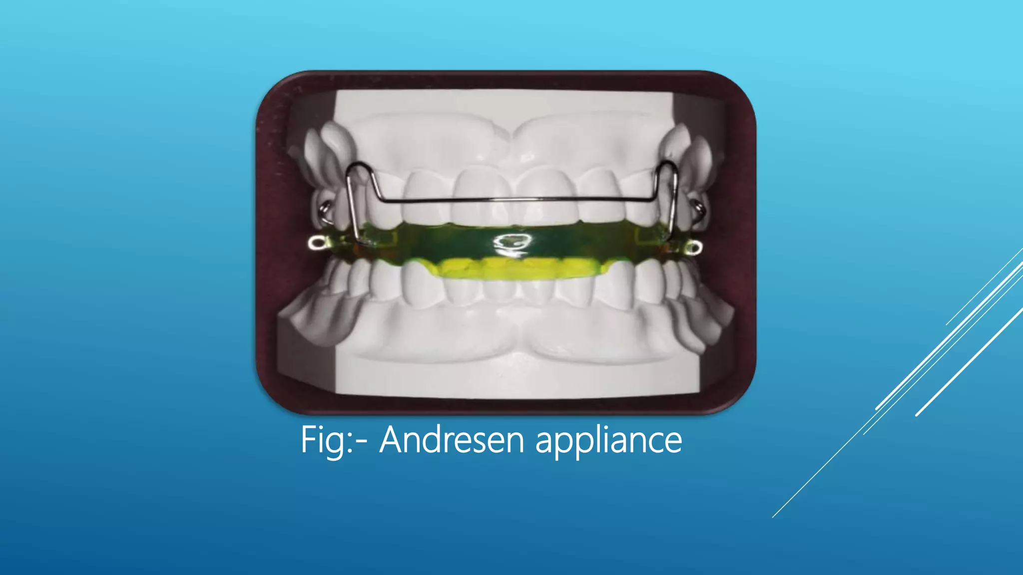 Oral screen and mixed dentition appliance | PPTX