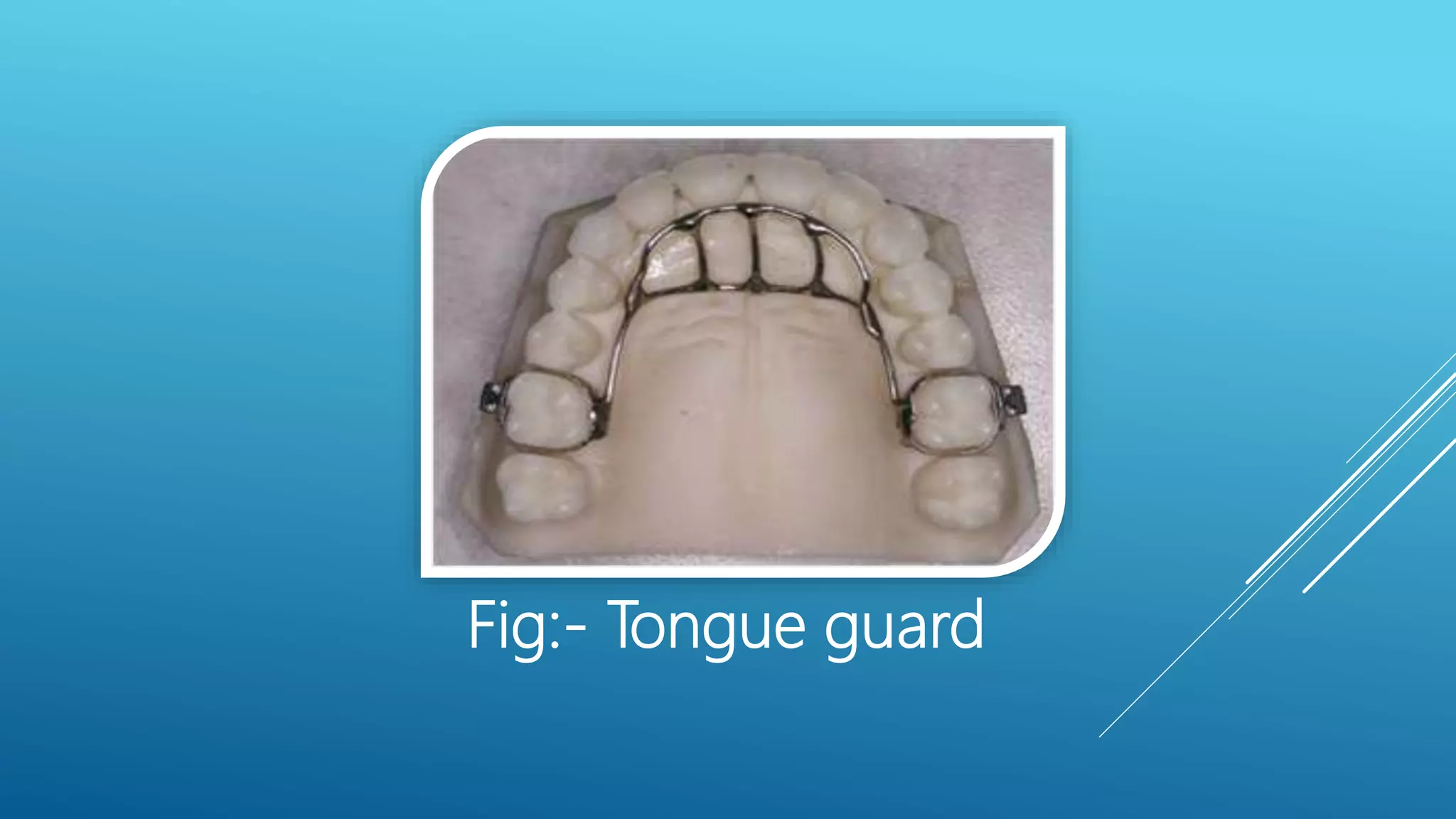 Oral screen and mixed dentition appliance | PPTX