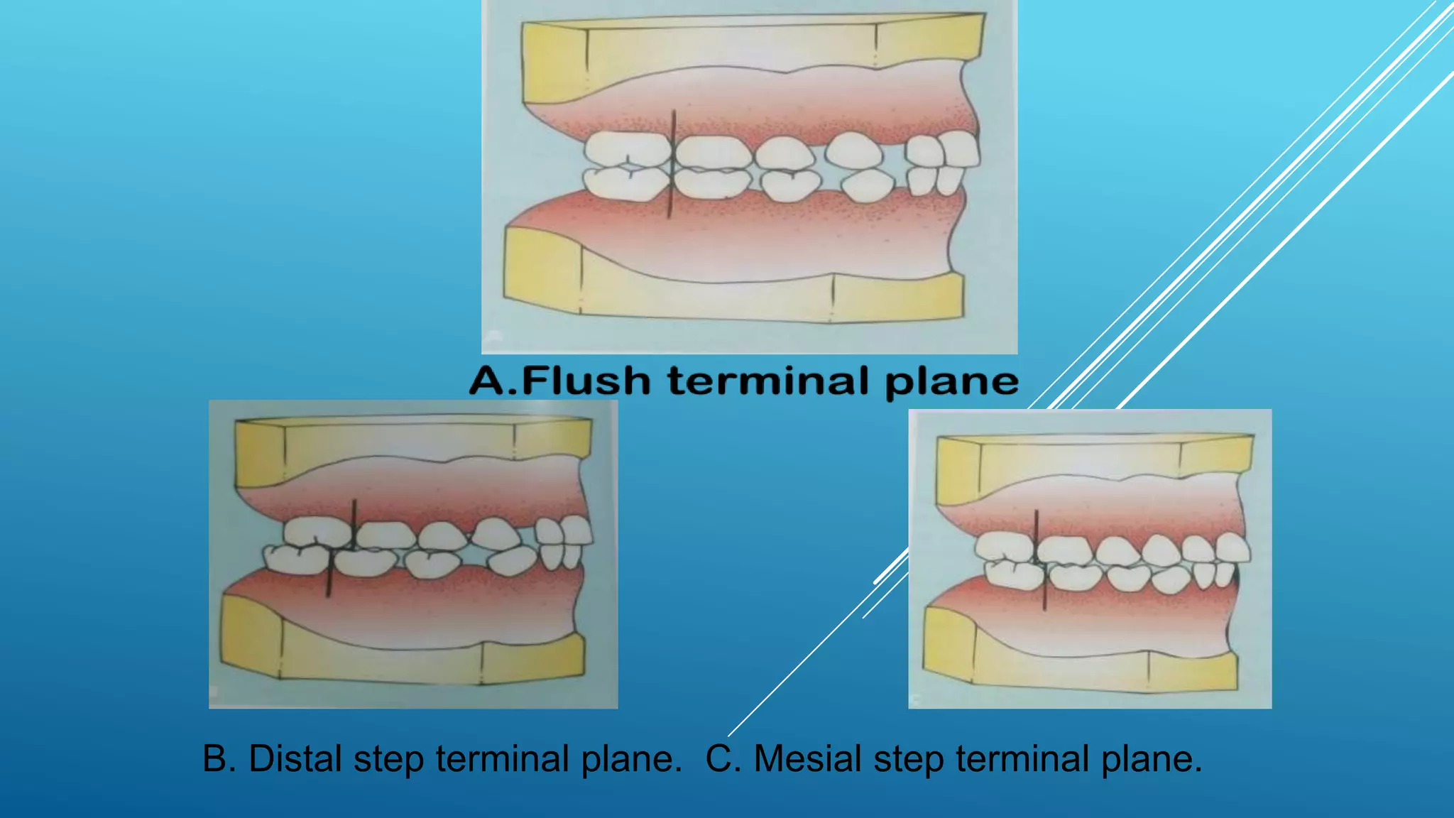Oral screen and mixed dentition appliance | PPTX