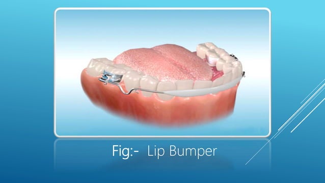 Oral screen and mixed dentition appliance | PPTX | Dental Health ...