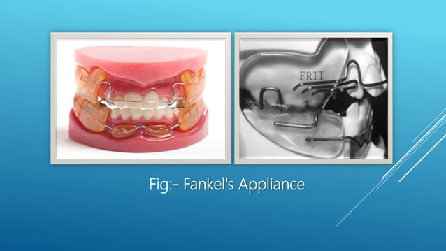 Oral screen and mixed dentition appliance | PPTX | Dental Health ...