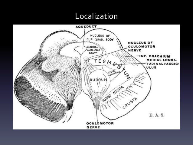 Wernekink commissure syndrome