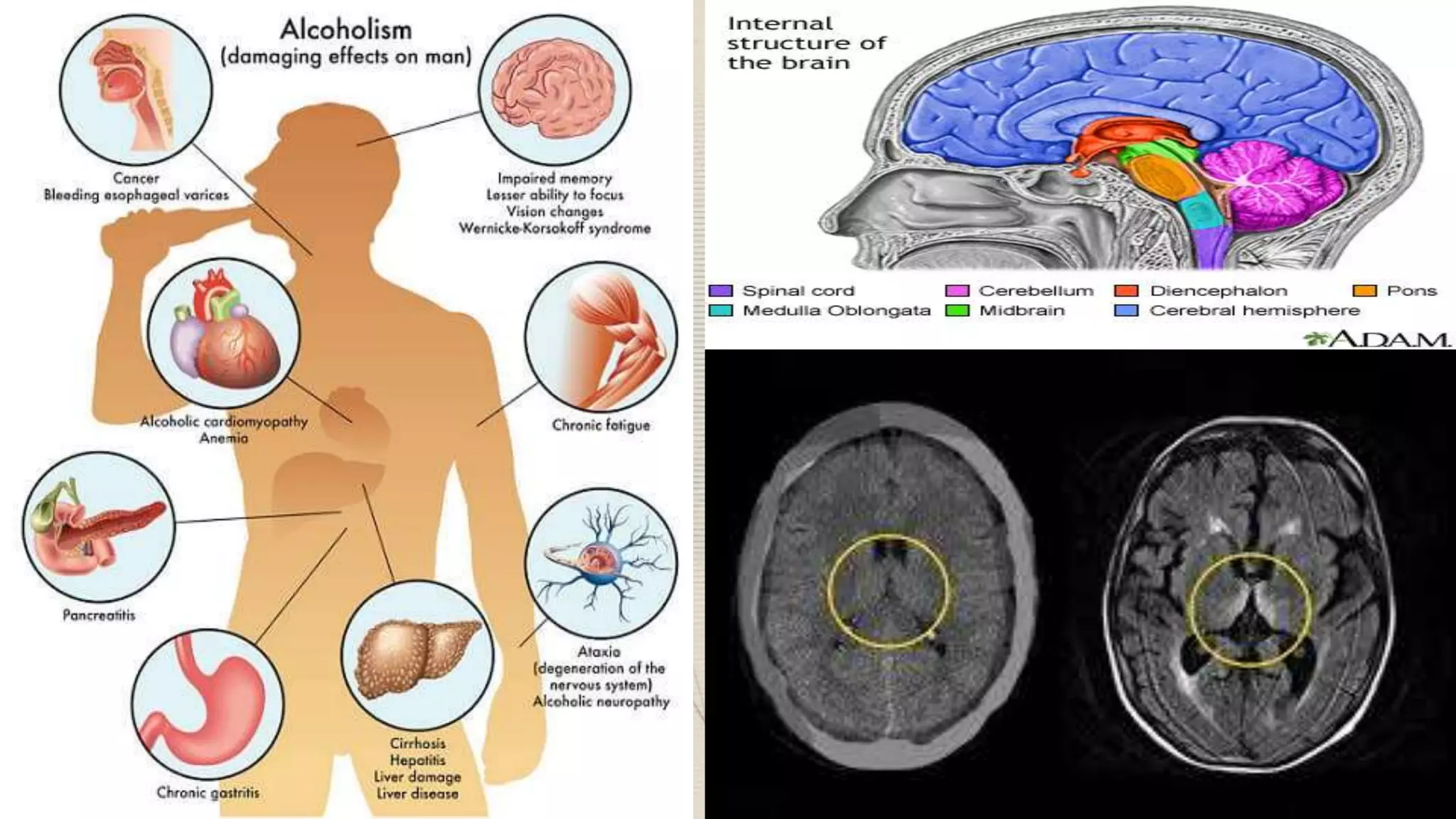 Wernicke korsakoff syndrome ppt | PPTX