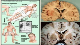 Wernicke korsakoff syndrome ppt | PPTX
