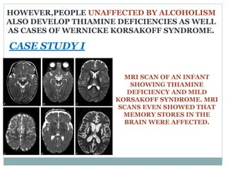Wernicke korsakoff's syndrome | PDF